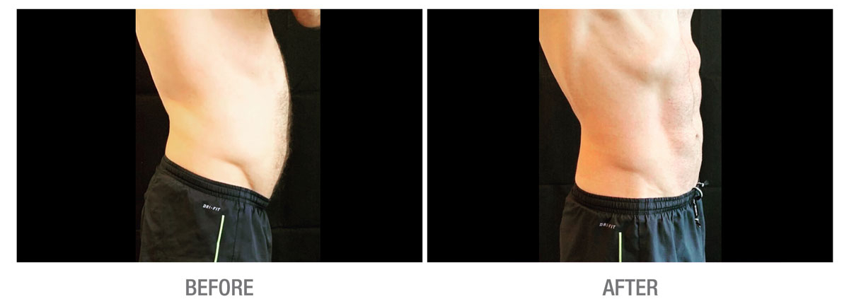 Body Sculpting | Reduce Body Fat | Countouring By Kate